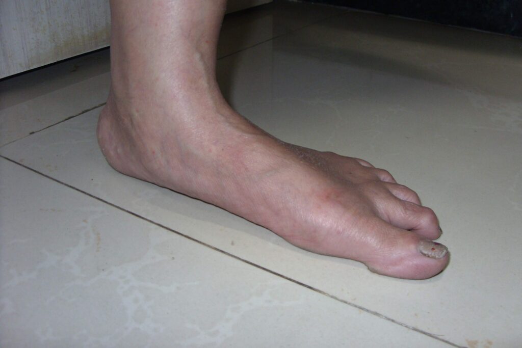Flat feet - Sole Motion