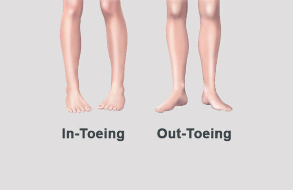In-toeing and Out-toeing: Is It Normal for Kids? - Sole Motion